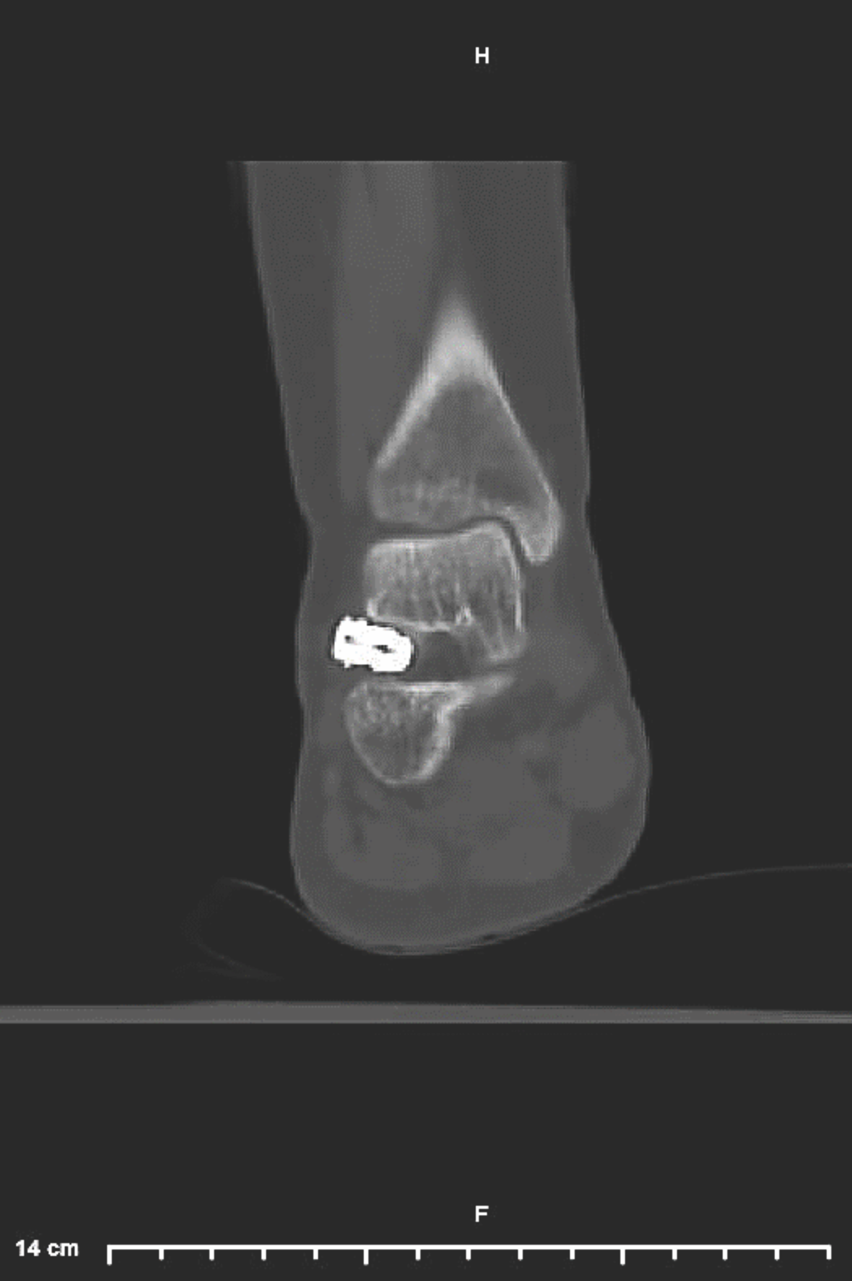 Correcting Flexible Flatfoot With Subtalar Arthroereisis | Podiatry Today
