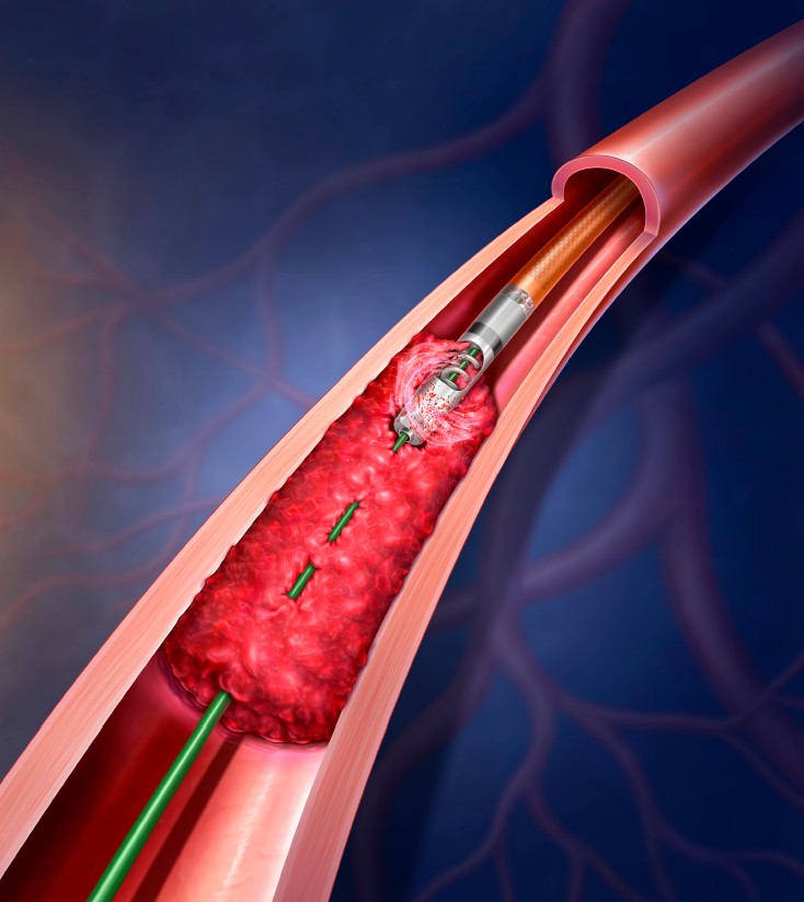BD to Initiate Real-World Patient Data Registry for the Rotarex ...