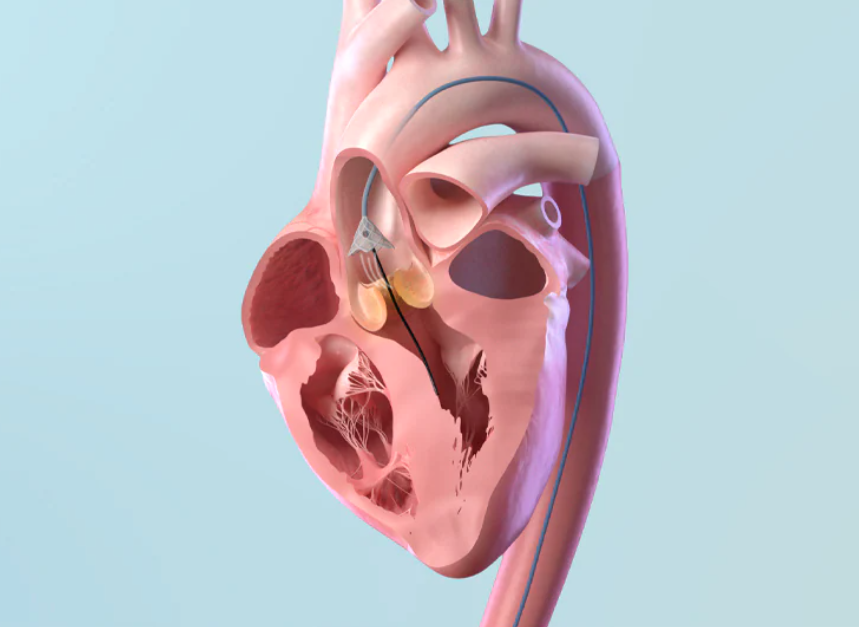 Novel Self-Centering Catheter Designed to Aid Retrograde Aortic Valve ...