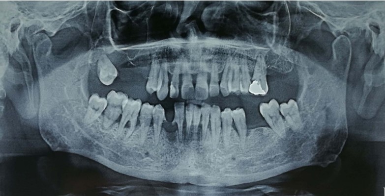 Carcinoma Cuniculatum of the Maxilla Mimicking Nonhealing Extraction ...