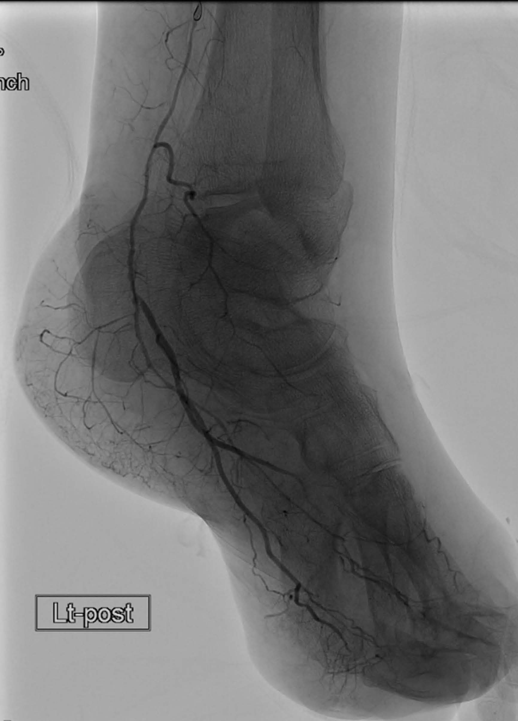 New Peripheral Vascular Microcatheters Save Procedure Time and Advance ...
