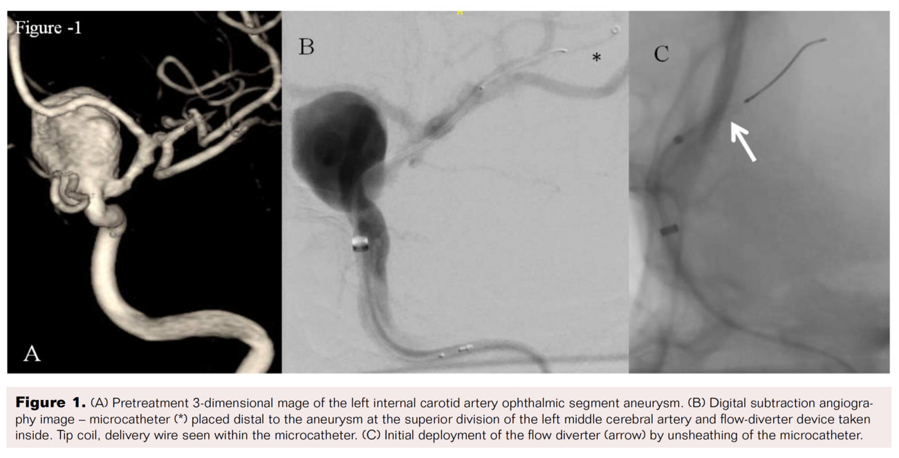 Intraprocedural Complication of a Flow Diverter During Treatment of ICA ...