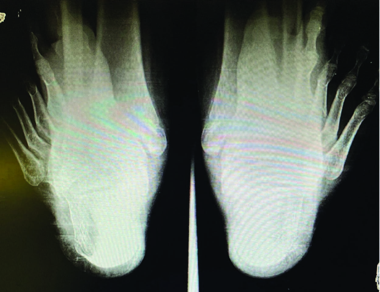 Treating Calcaneal Apophysitis