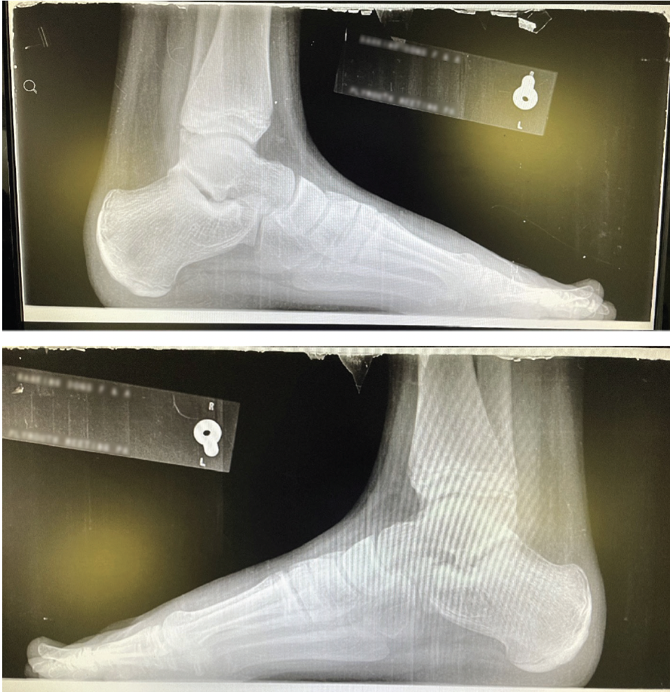 Treating Calcaneal Apophysitis