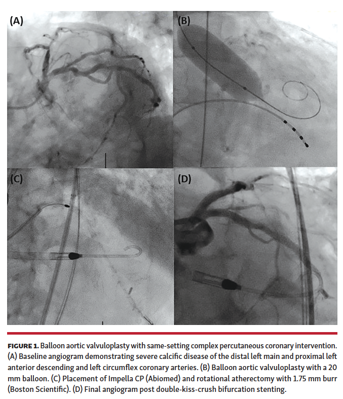 Balloon Aortic Valvuloplasty With Same-Setting Complex Percutaneous ...