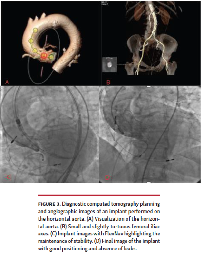 The Novel FlexNav Delivery System for Transcatheter Aortic Valve ...
