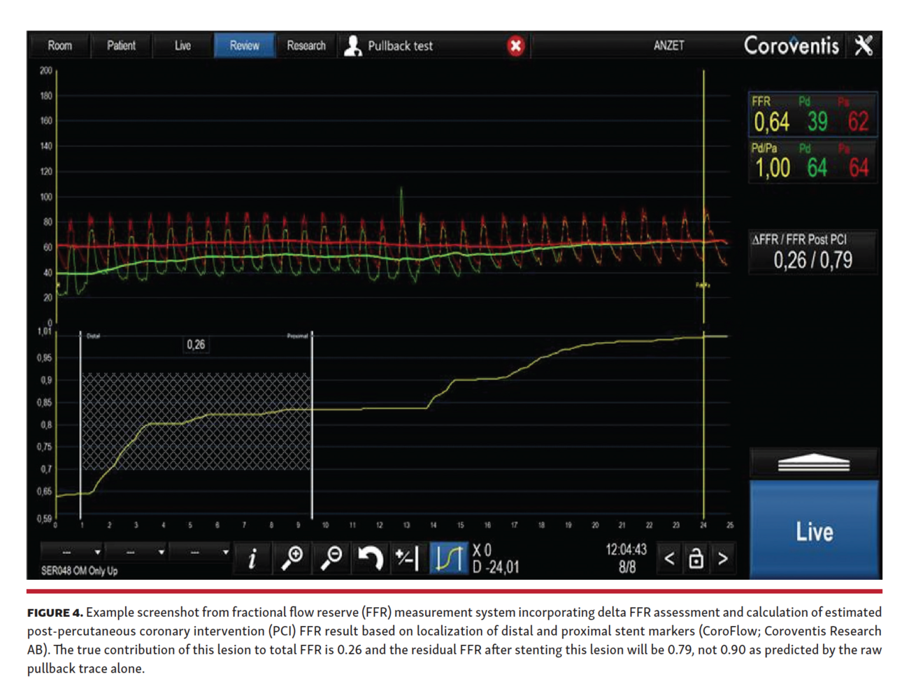 Clinical Utility of Novel Fractional Flow Reserve Pullback for ...