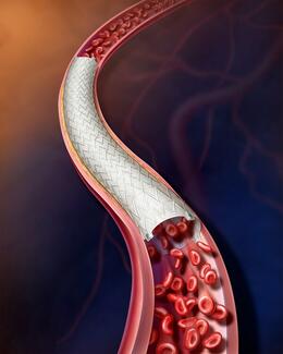 Balloon-Expandable Covered Stent to Superficial Femoral Artery