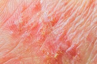 Spongiotic Dermatitis: Differential Diagnosis and Elusive Etiology