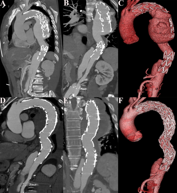 Successful Re-endovascular Intervention of Distal Stent Graft-Induced ...