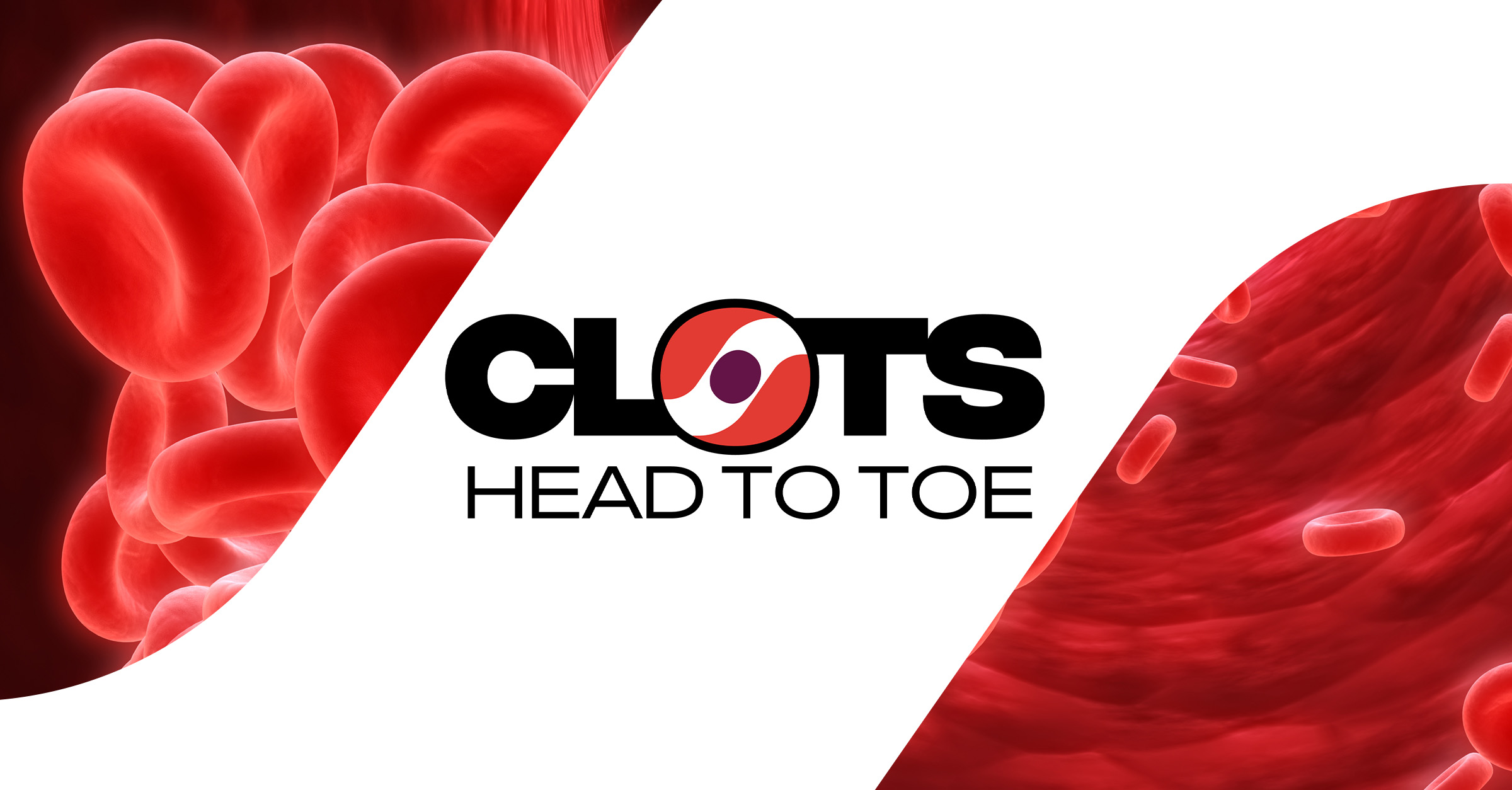 Home | Clots: Head To Toe